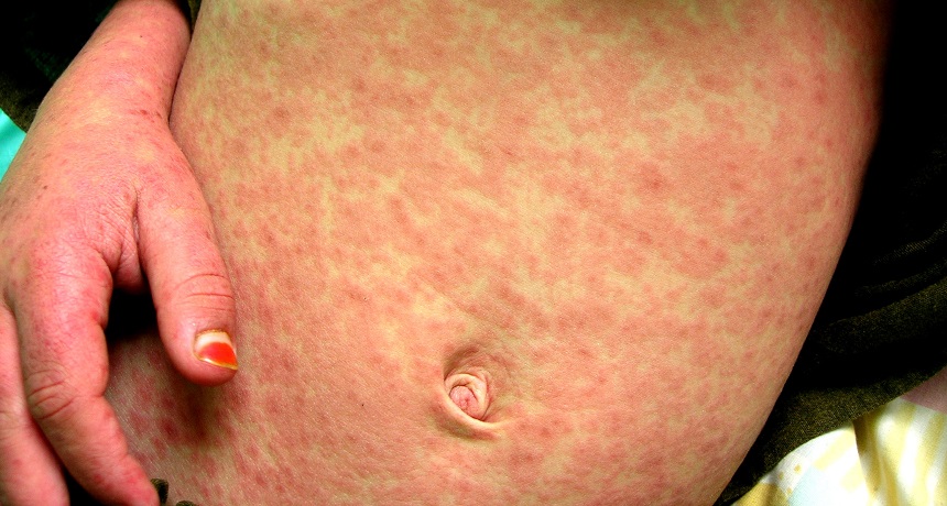 10 things to know about measles